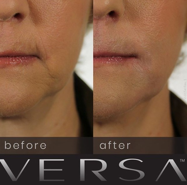 Revanesse Versa Dermal Filler Before And After Photos | Palm Springs