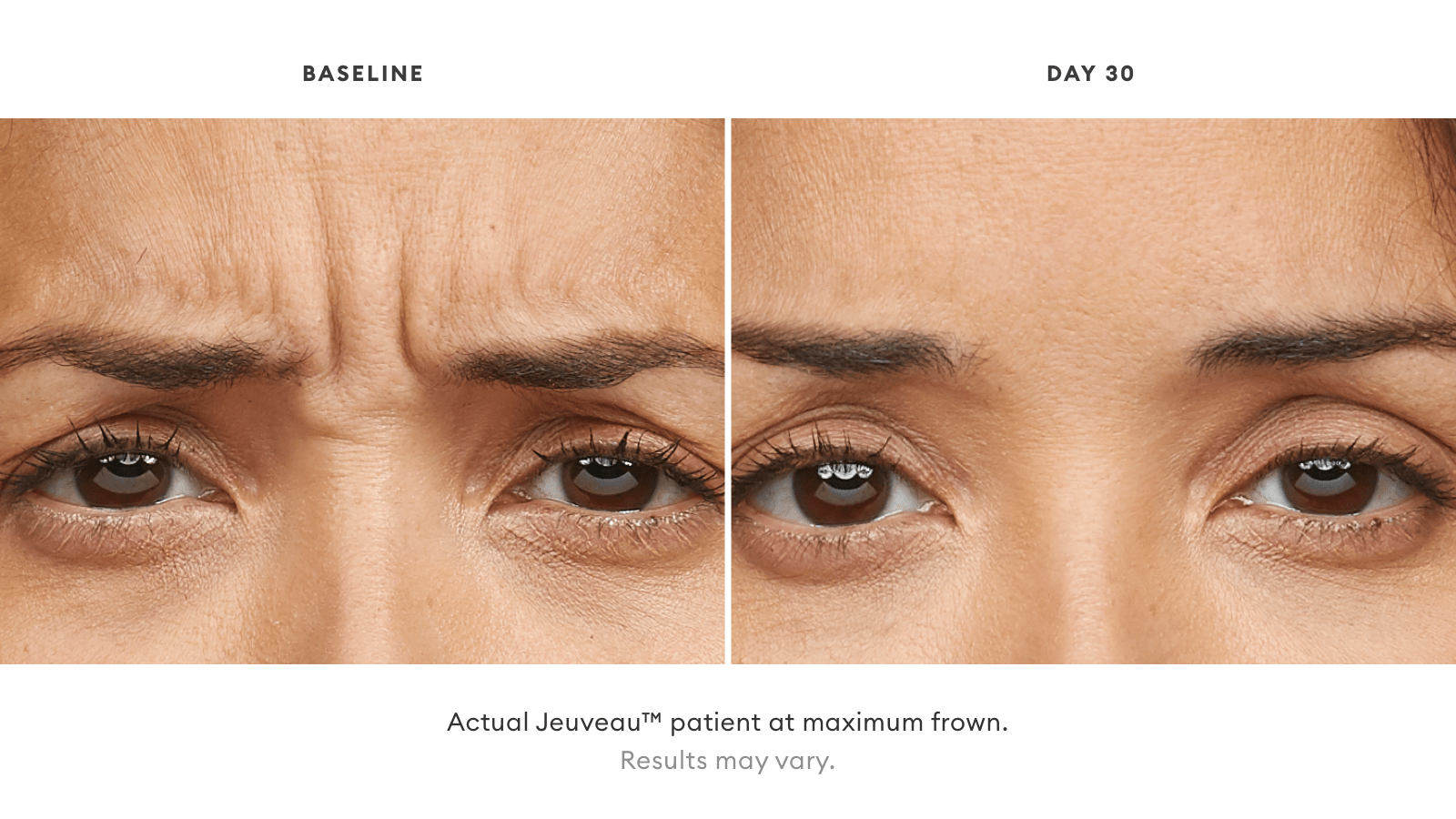 Jeuveau vs. Botox: What's The Difference? - Palm Springs | Beverly ...